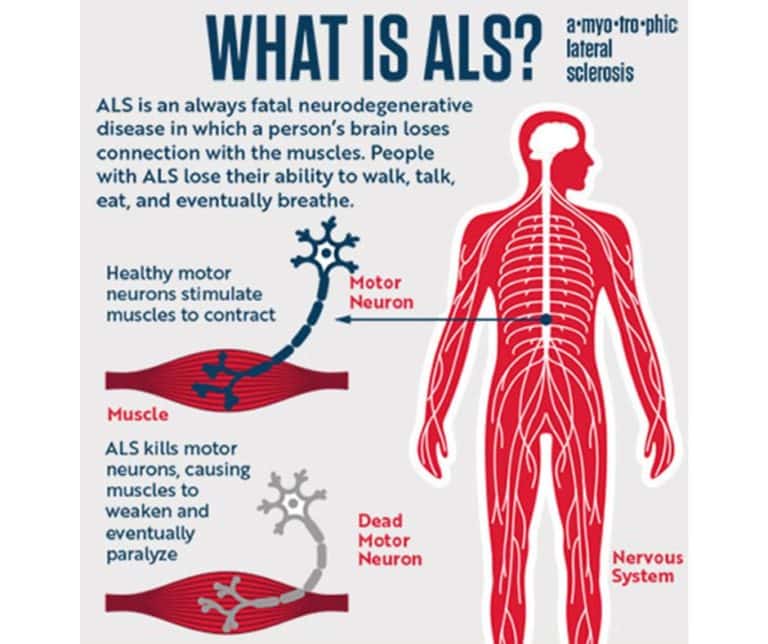 What is ALS? Understanding the Disease and Our Mission to Fight It ...